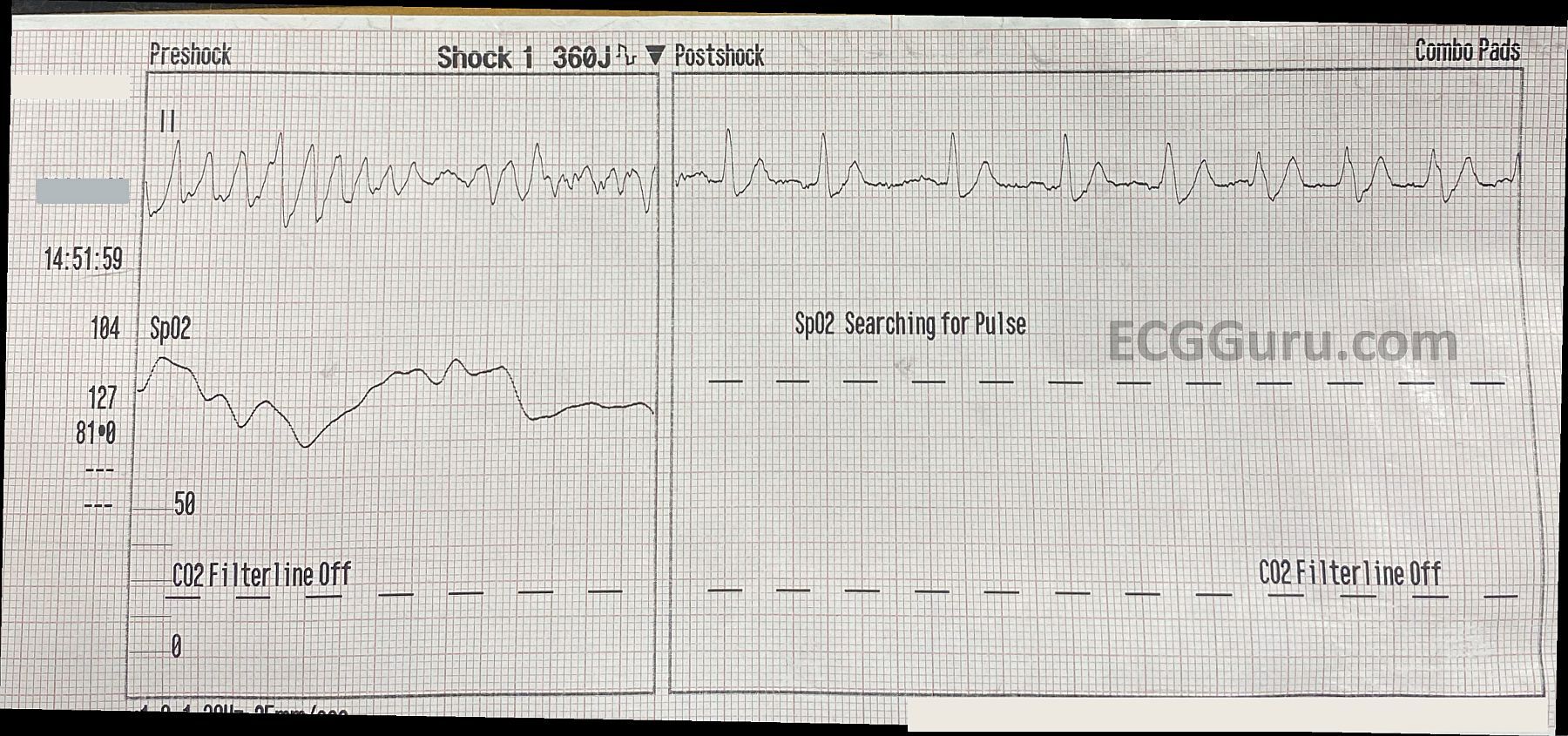 Coarse Ventricular Tachycardia